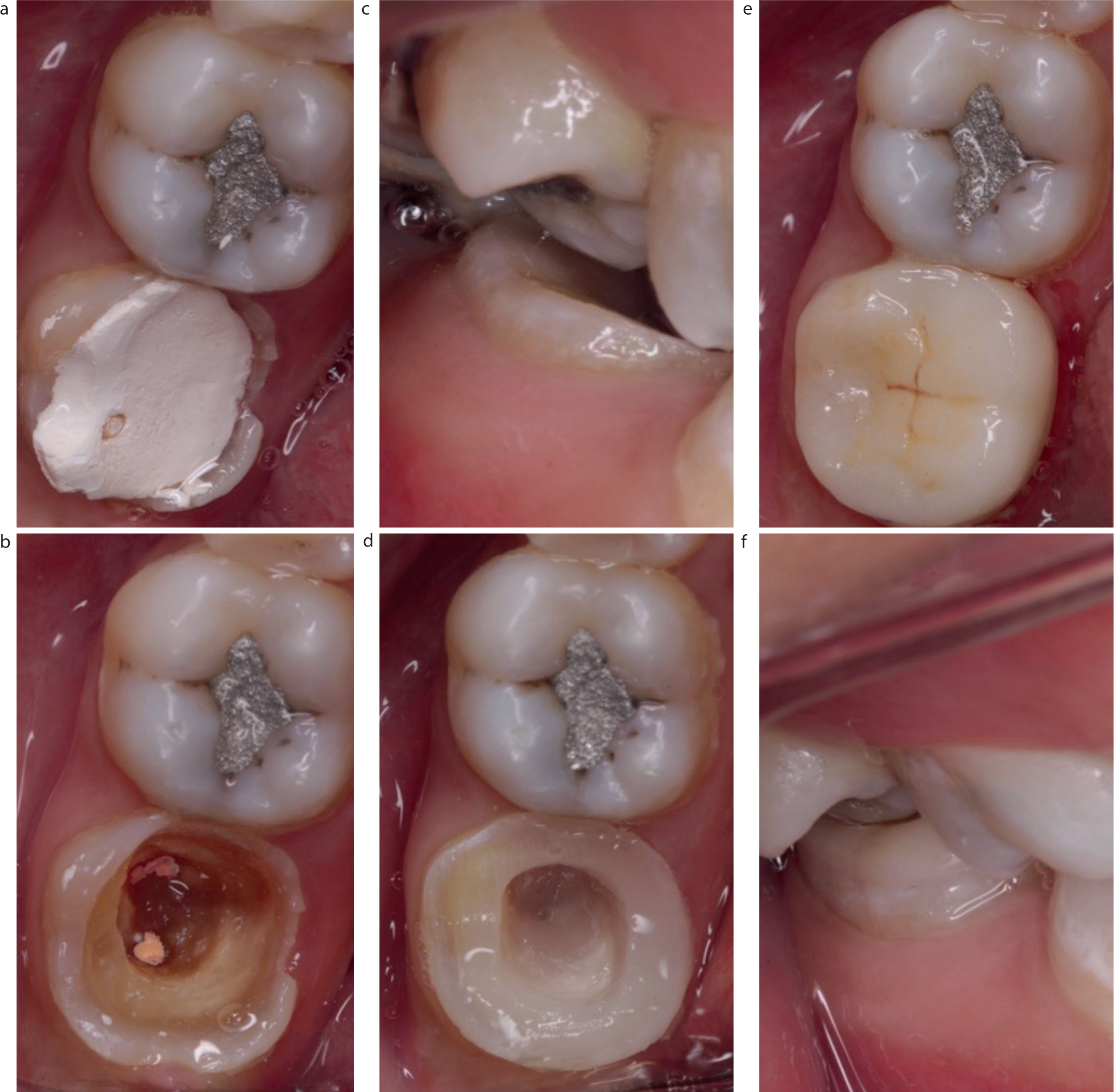 Tổng quan về Endocrown, Overlay và Onlay trong Phục hồi Răng Sau Điều ...